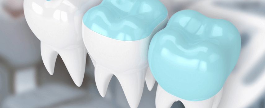 Inley ve Onley Diş Restorasyonları Ne Zaman Tercih Edilmeli? | Pepuza ...